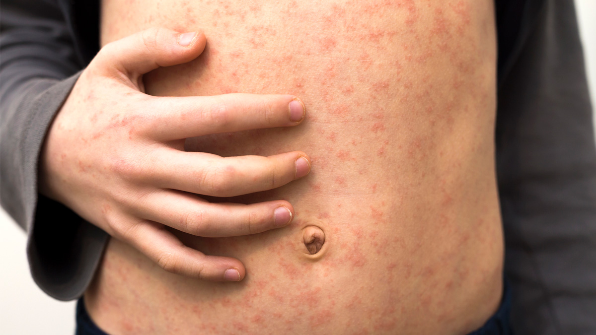 Rougeole : causes, symptômes et traitements