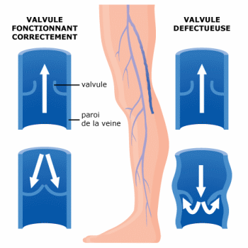 Varices